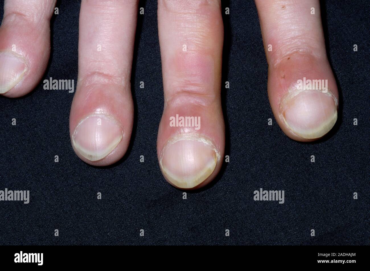 Clubbed fingers of a 32 year old man. Clubbing of the fingers is often ...