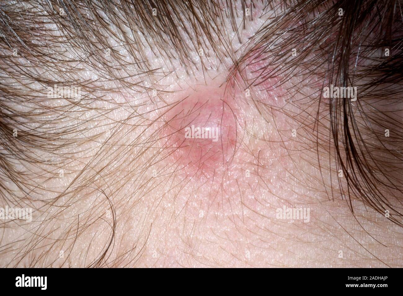 Cyst On Back Of Neck