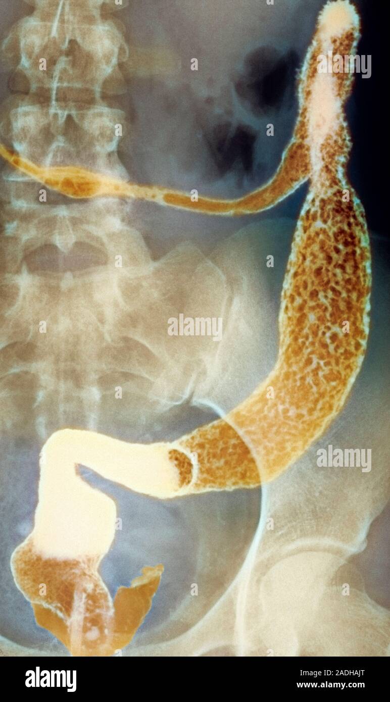 Inflamed colon and rectum. Coloured X-ray of part of the colon and the ...