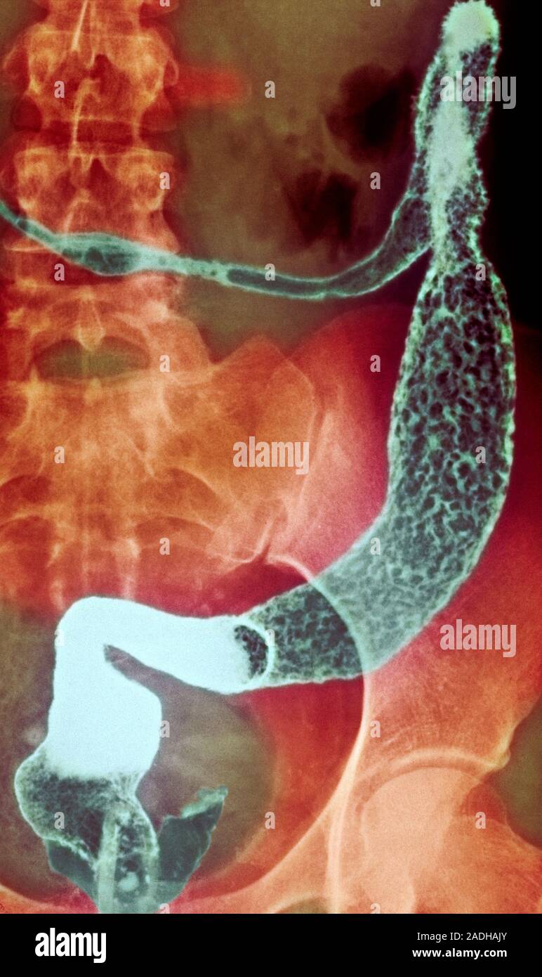 Inflamed colon and rectum. Coloured X-ray of part of the colon and the ...