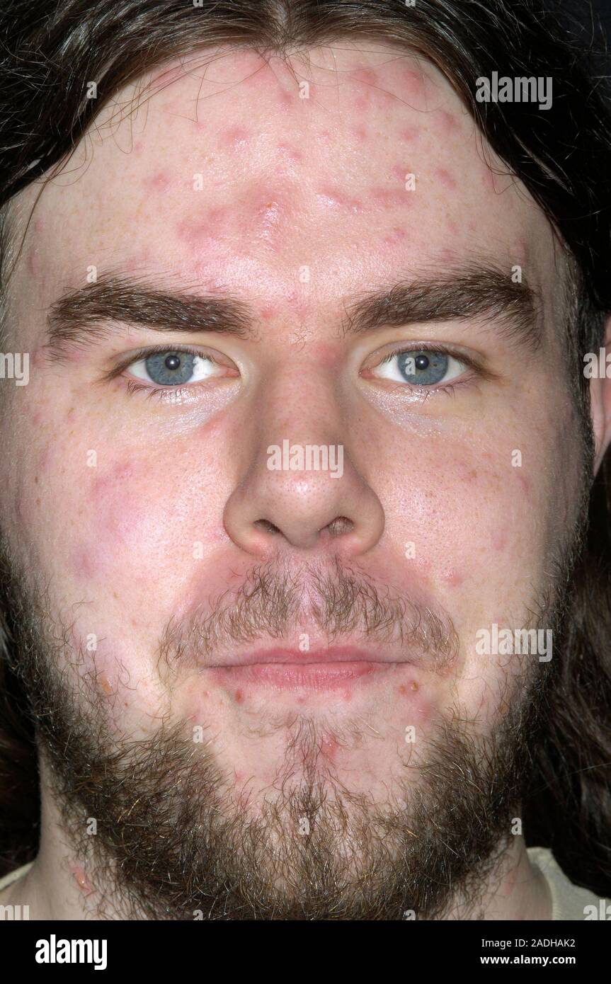 MODEL RELEASED. Chickenpox blisters on the face of a 20 year old man ...