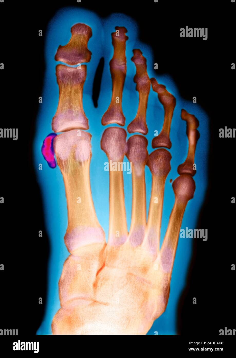 Calcified toe bone. Coloured X-ray of the calcified big toe bone of a ...