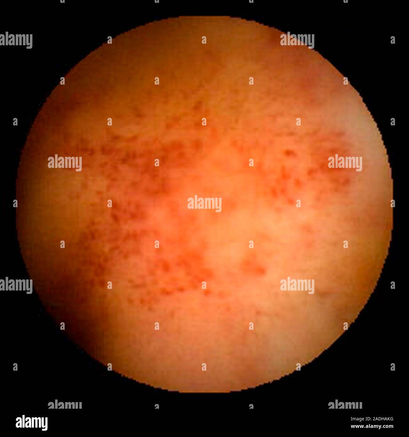 Crohn's disease, pill camera view. The lining of the ileum, the last ...