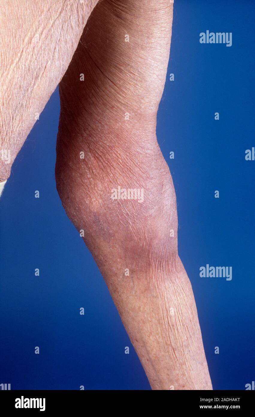 Baker's cyst. Swollen leg of a patient with a Baker's, or popliteal ...