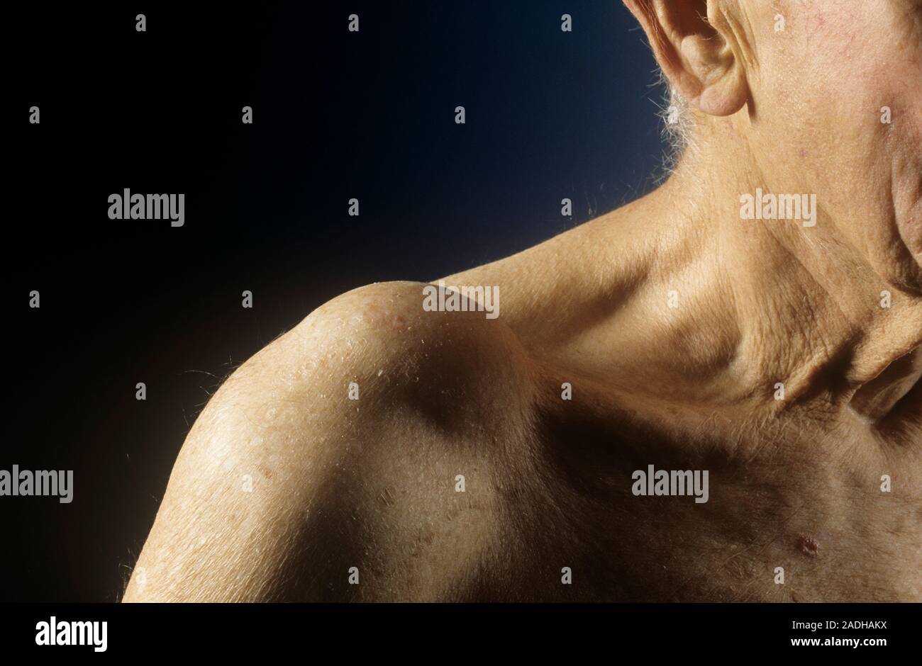Shoulder joint cyst. Elderly patient with a cyst at their ...
