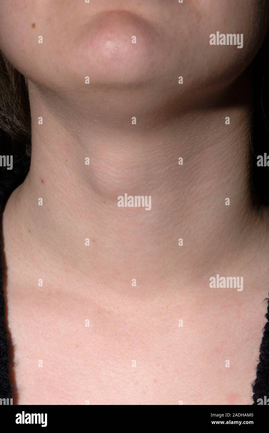 Thyroglossal cyst (swelling) in a 23-year-old woman's neck. Also known ...