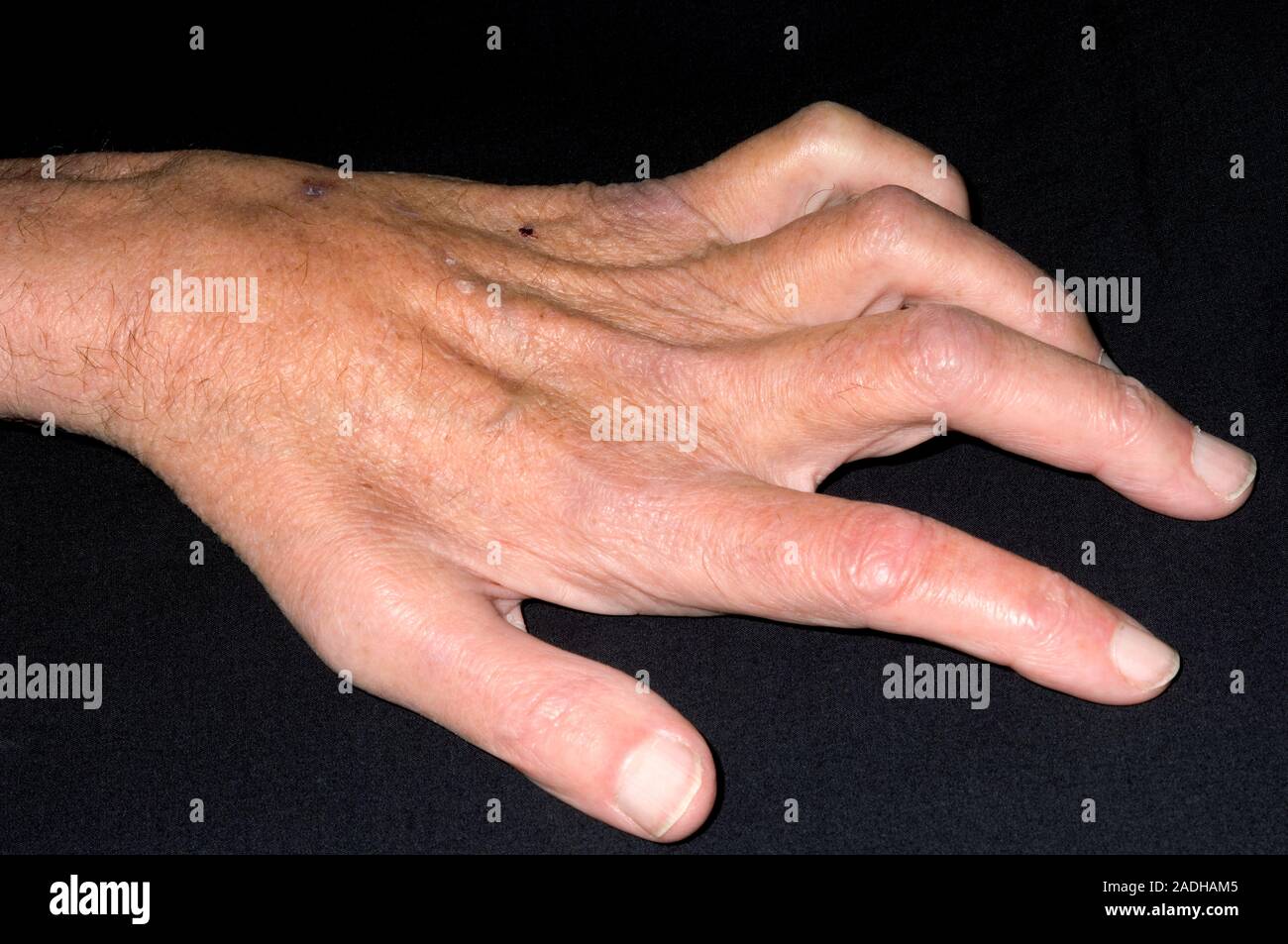 Claw hand due to nerve compression in a 73-year-old man. The ...