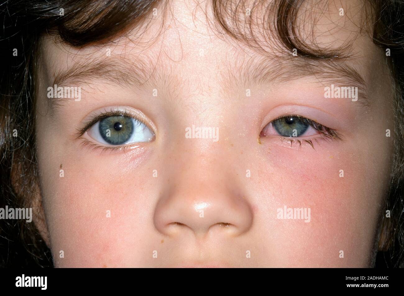 MODEL RELEASED. Periorbital cellulitis. Swollen tissue around the eye ...