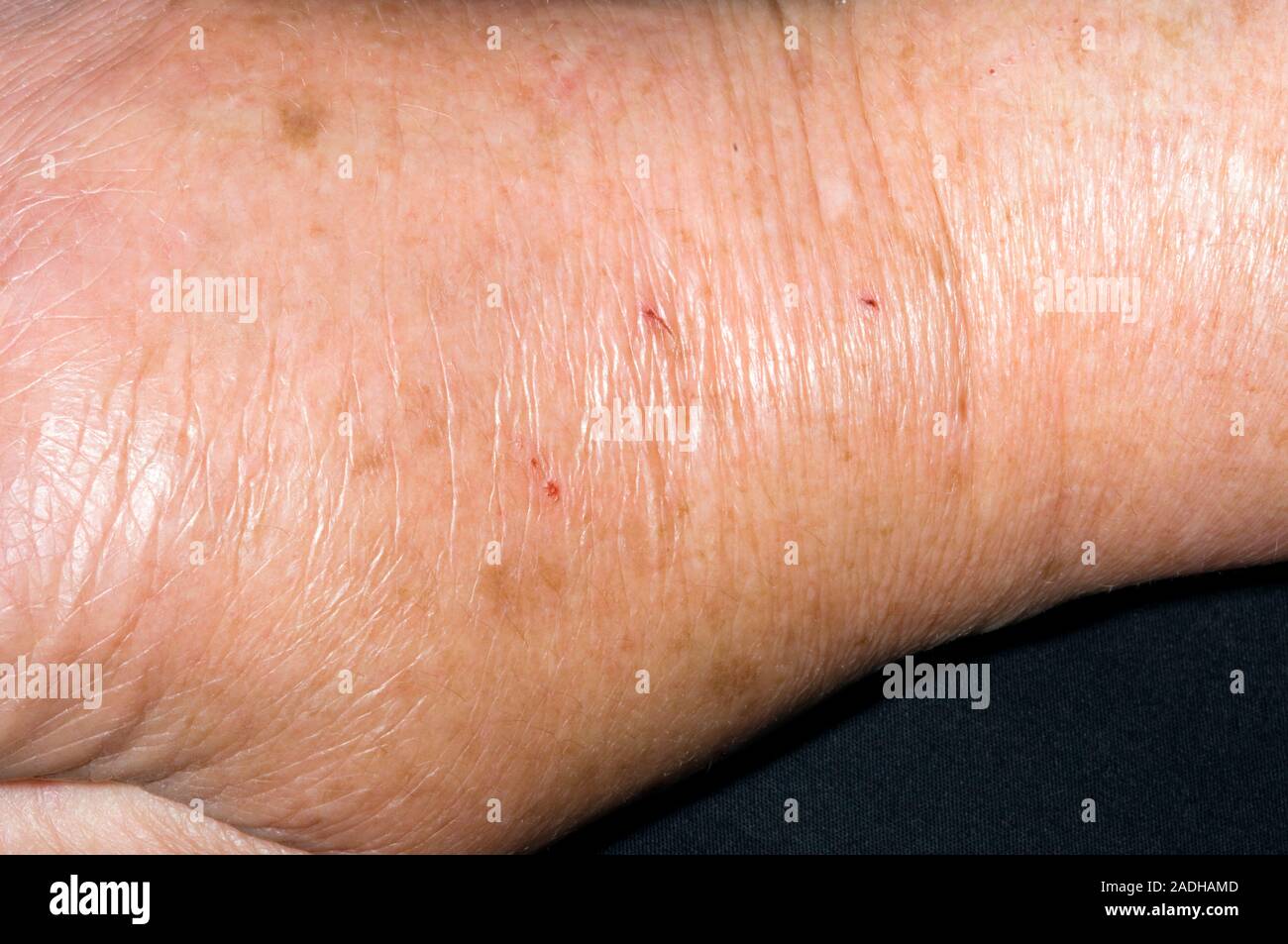 Cellulitis on a 55 year old woman's hand caused by catching her hand on ...