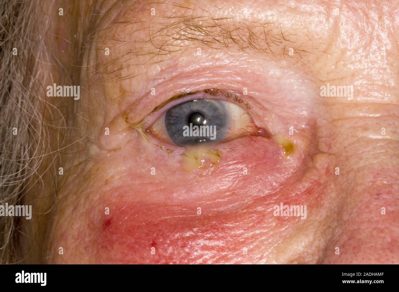 Orbital cellulitis. Eye of an 80 year old woman with orbital cellulitis ...