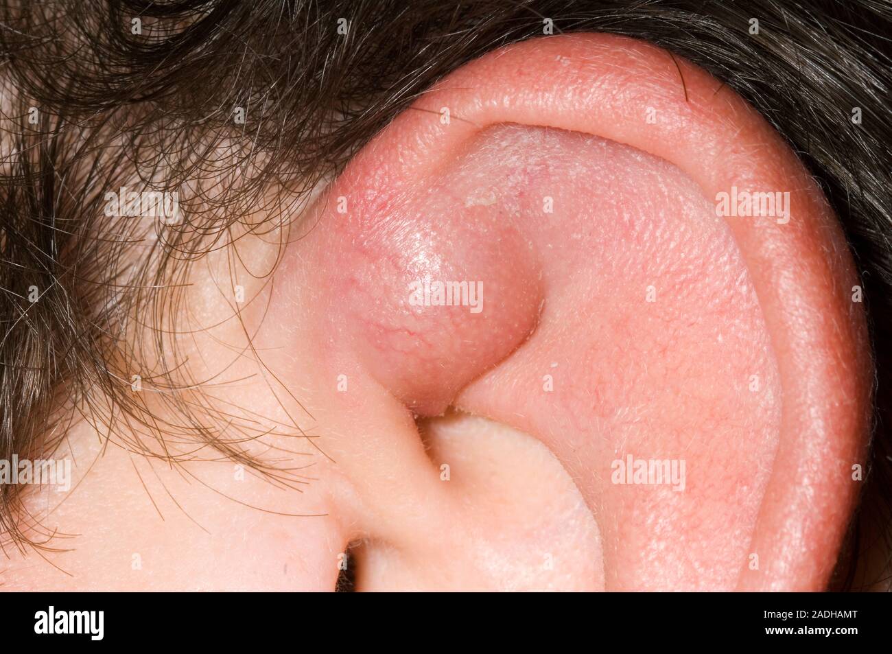 MODEL RELEASED. Infected dermoid cyst on a 38 year old man's ear. A ...