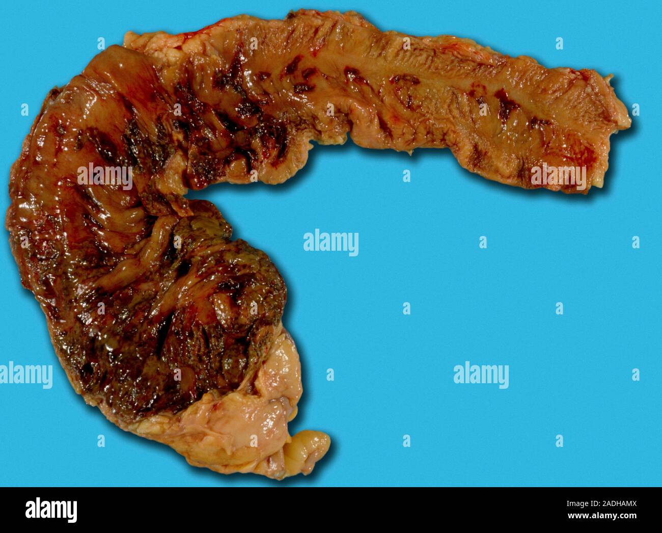 Ischaemic colitis, gross specimen. Ischaemic colitis is inflammation of ...