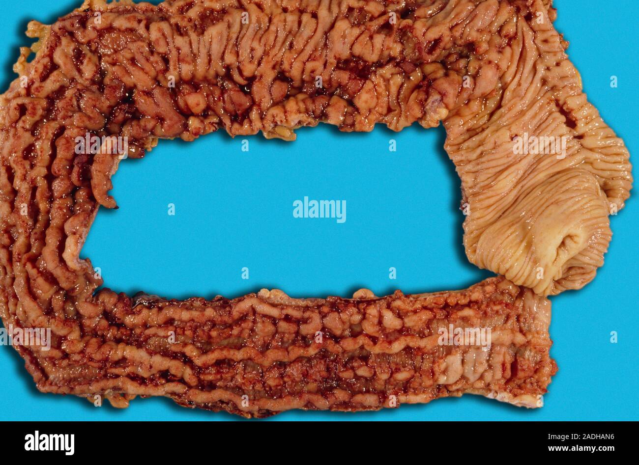 Crohn's disease colon, gross specimen. Raised mucosal areas of swollen ...