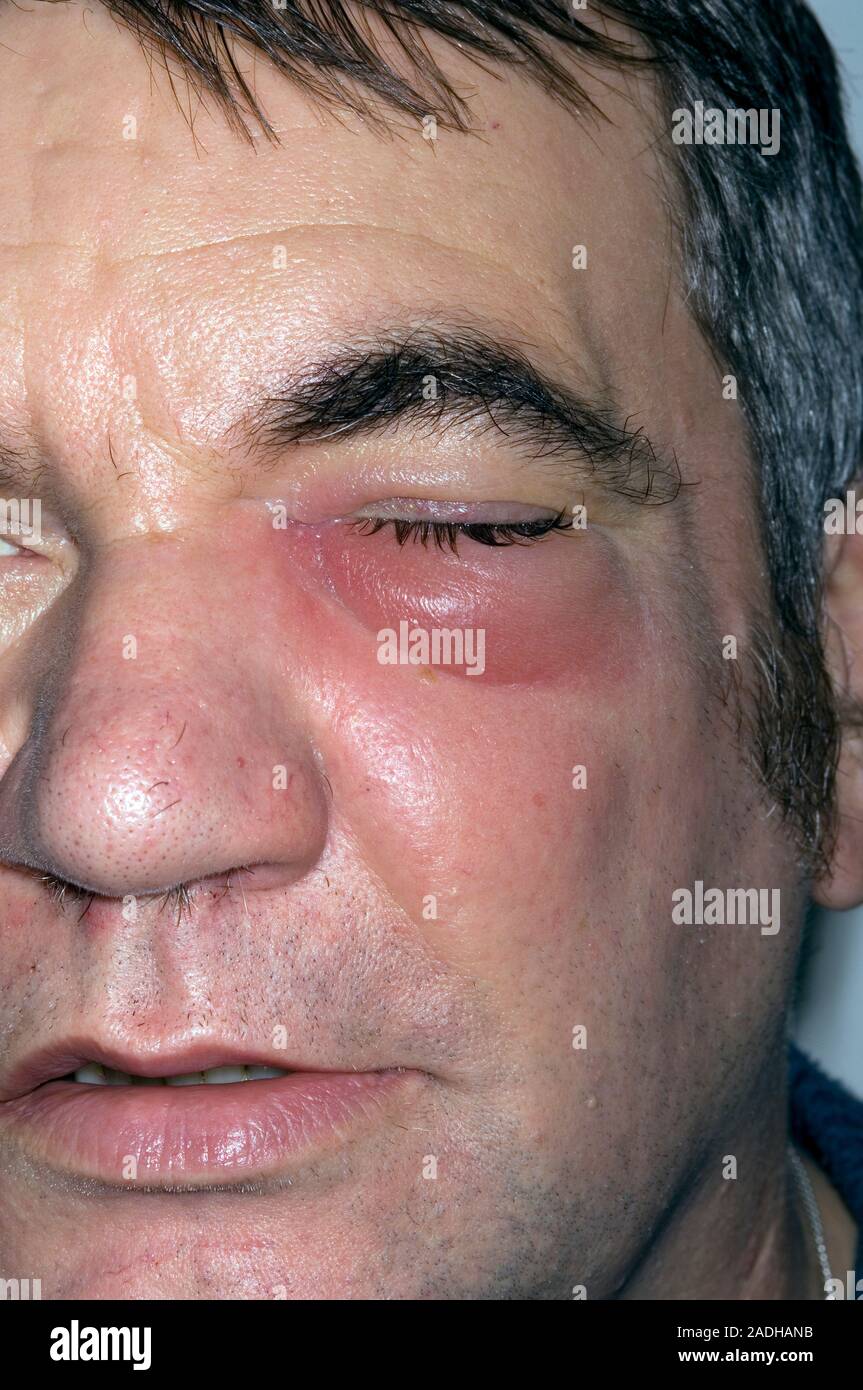 MODEL RELEASED. Periorbital cellulitis. Swollen tissue around the eye ...