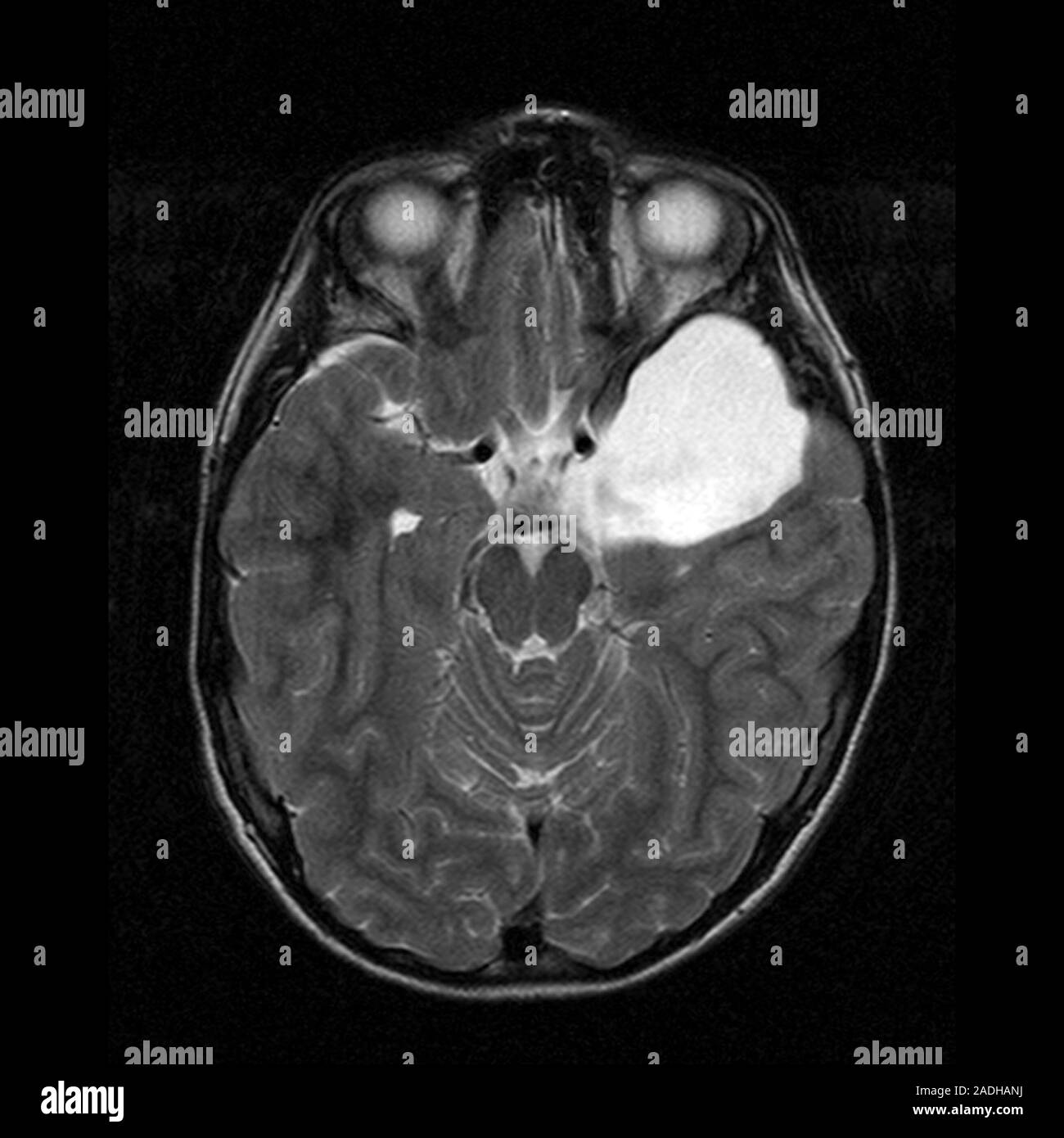 Arachnoid Cyst Magnetic Resonance Imaging Mri Scan Of An Axial