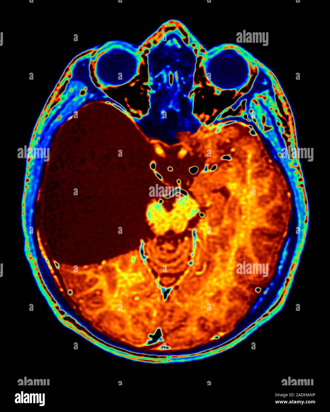 Arachnoid cyst. Coloured magnetic resonance imaging (MRI) scan of an axial (horizontal) section ...