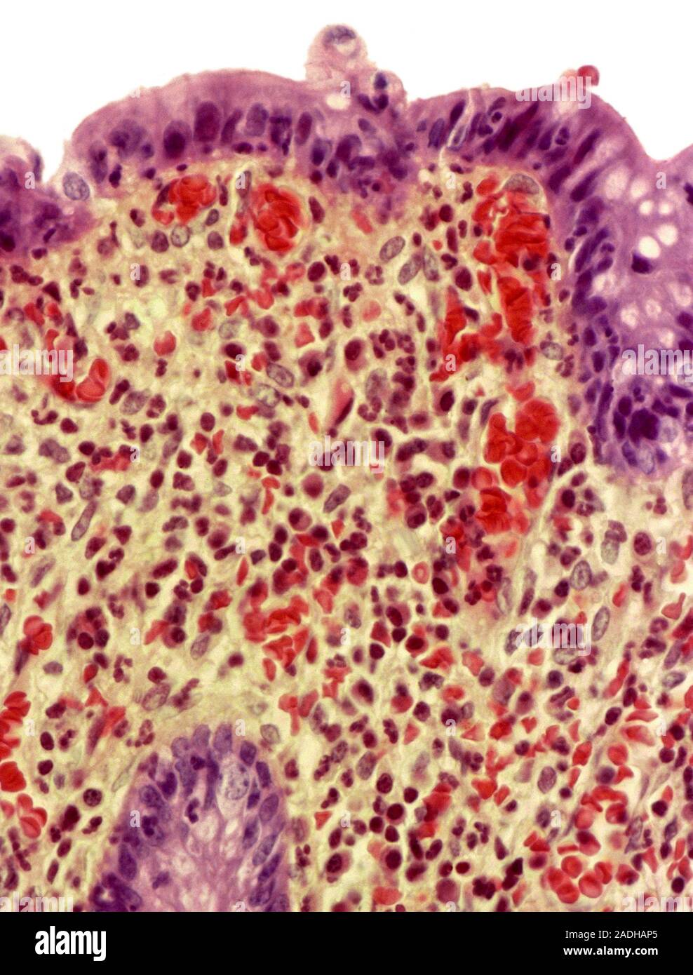Ulcerative colitis. Light micrograph of a section through the bowel ...