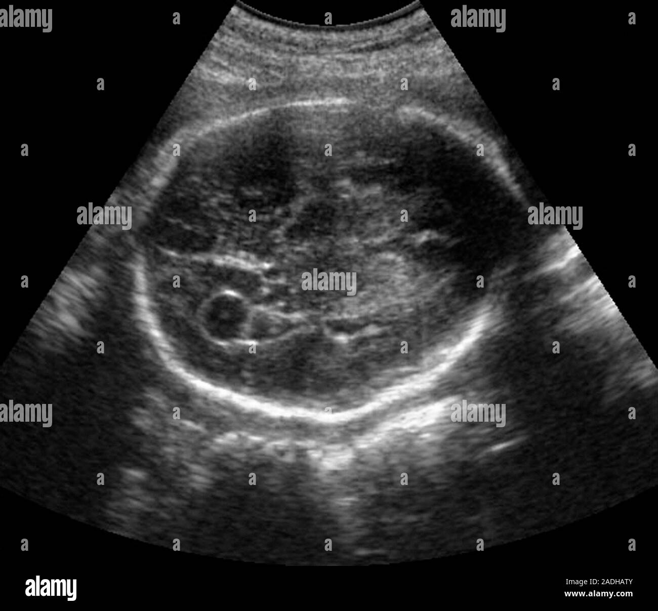 Choroid Plexus Cyst Ultrasound Scan Of A Foetus Brain With A Choroid Plexus Cyst Cpc The