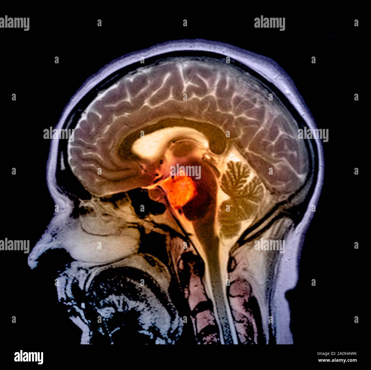 Brain cyst. Coloured magnetic resonance imaging (MRI) scan of a ...