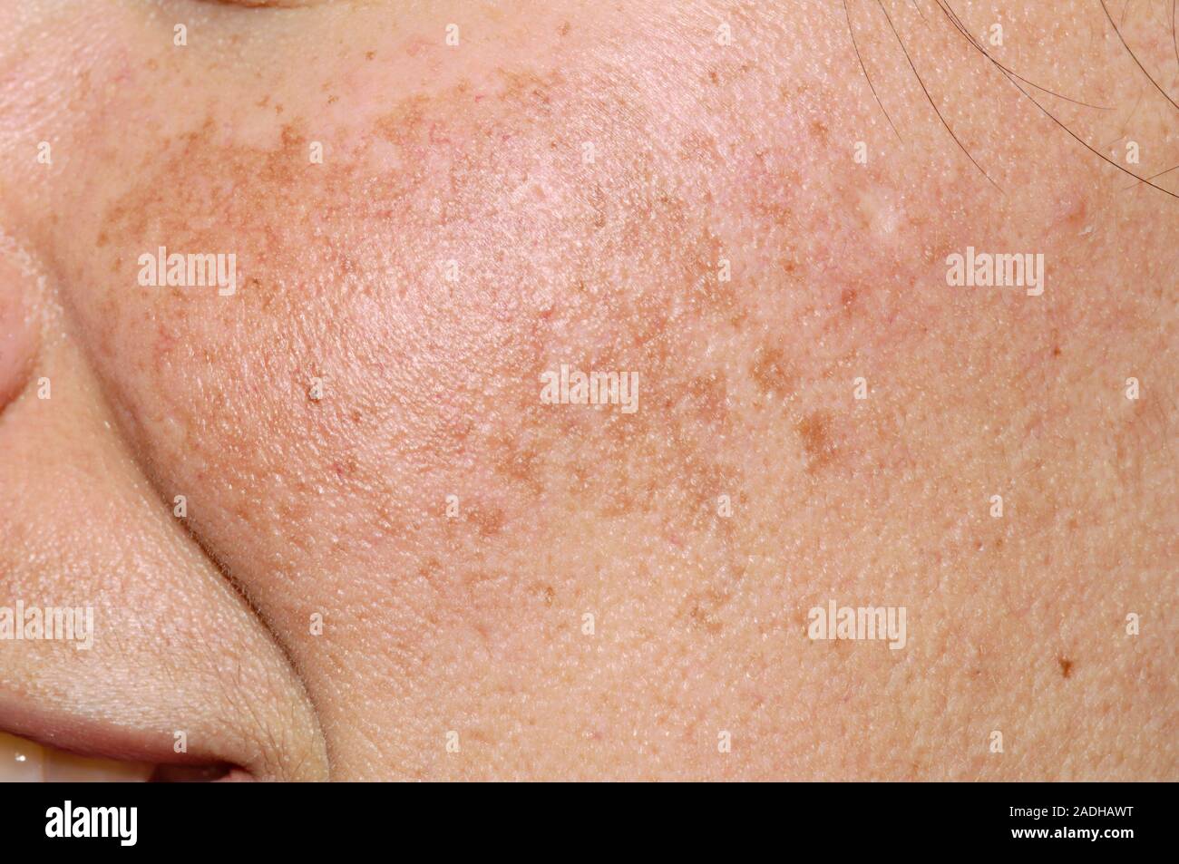 Chloasma on a 43 year old woman's cheek. Also called melasma, these ...