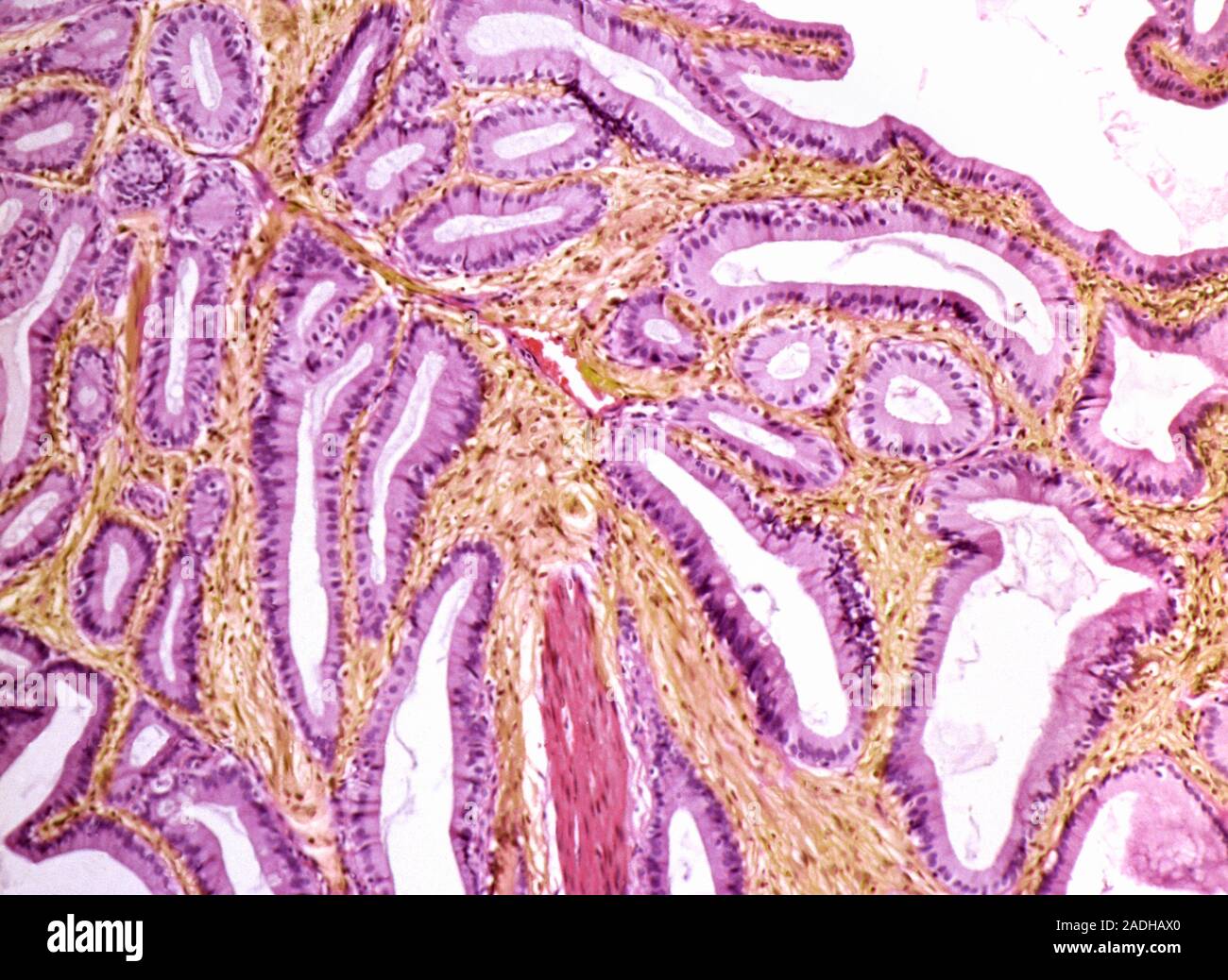 Inflamed gall bladder. Light micrograph of a section through a gall ...