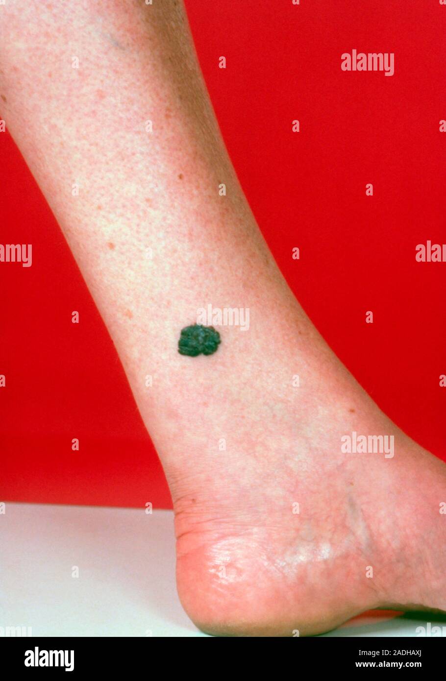A malignant melanoma affecting the lower part of a leg. Melanomas are ...