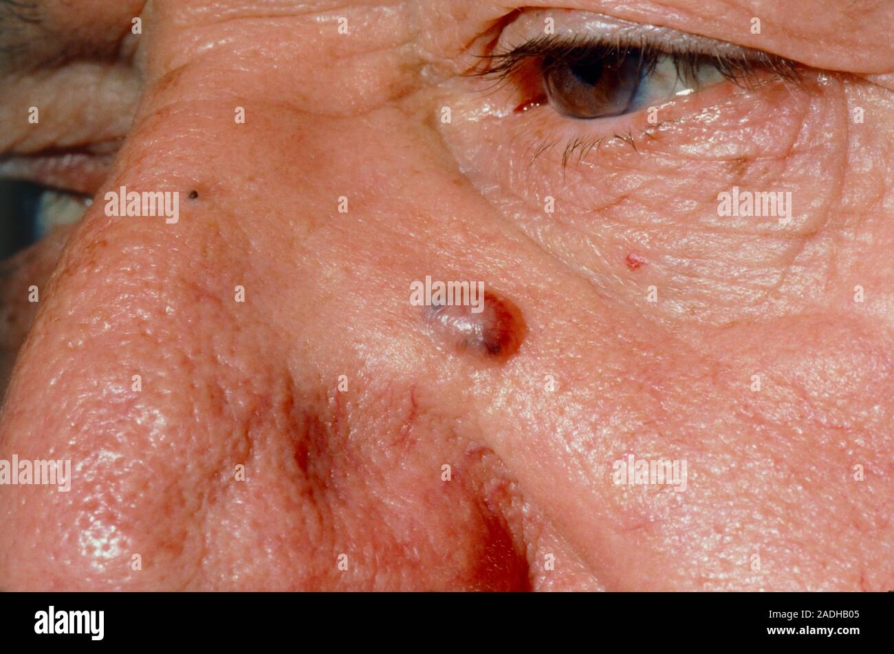 Basal cell carcinoma (rodent ulcer) on a man's face. Basal cell ...