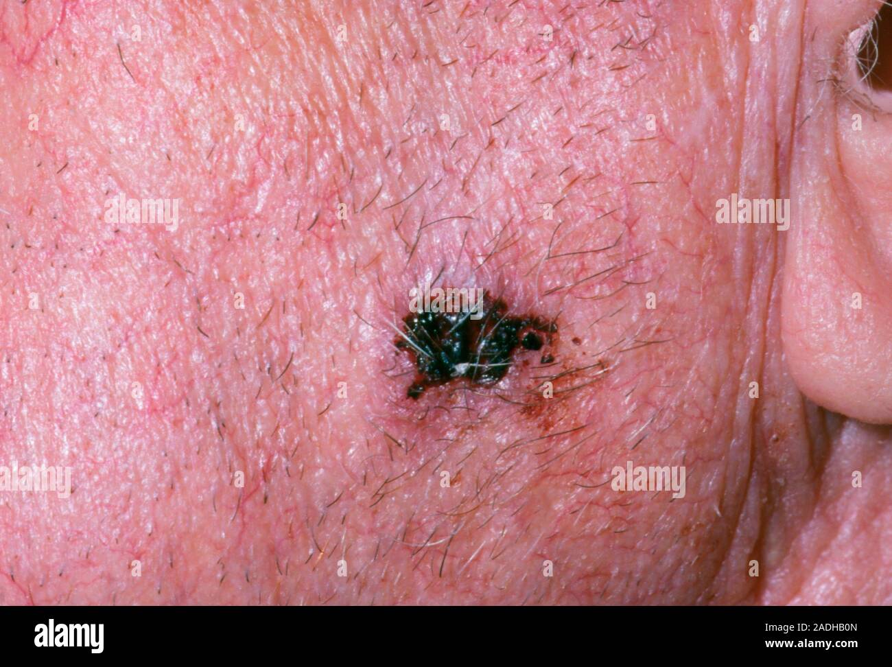 Basal cell carcinoma. Close-up of a skin tumour on the cheek of an ...