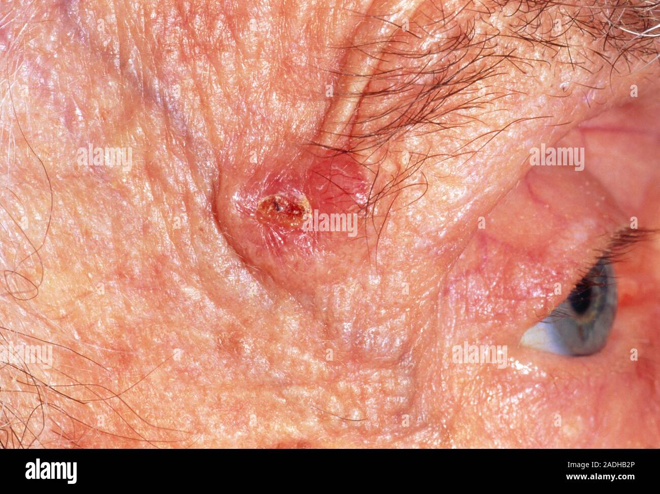 Basal cell carcinoma. First of two images. Close-up of a basal cell ...