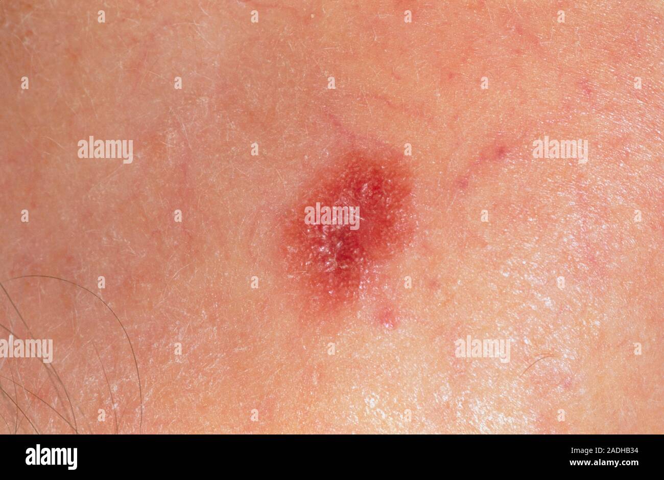 Melanoma. Close-up of an amelanotic (or unpigmented) malignant melanoma ...