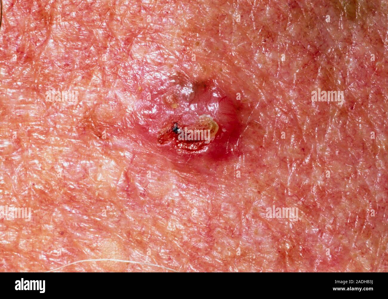 Basal Cell Carcinoma View Of A Basal Cell Carcinoma Or Rodent Ulcer