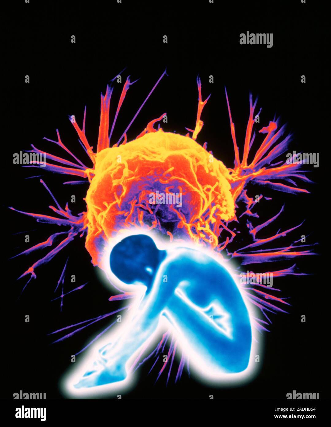 Cancer. Composite image of a female cancer patient and a coloured ...