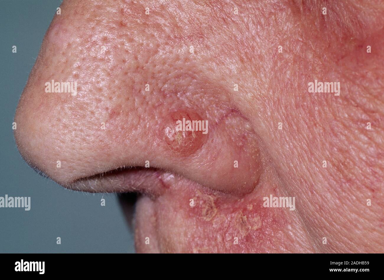 Skin cancer. Close-up of a basal cell carcinoma, a form of skin cancer ...