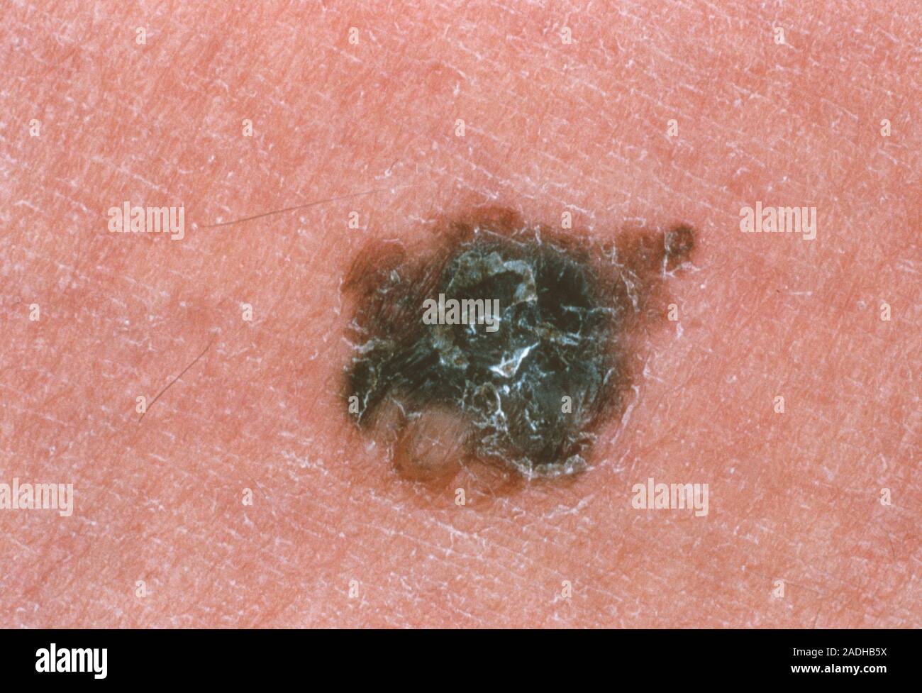 Melanoma. Close-up of a malignant melanoma skin cancer. Melanomas are ...