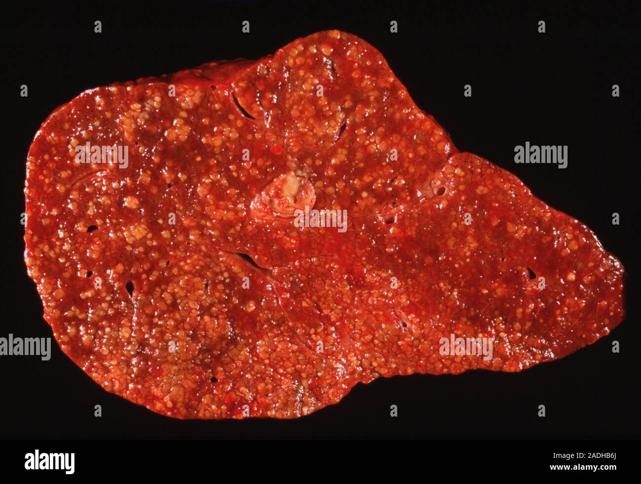 Liver cancer. Sectioned gross clinical specimen of primary malignant ...