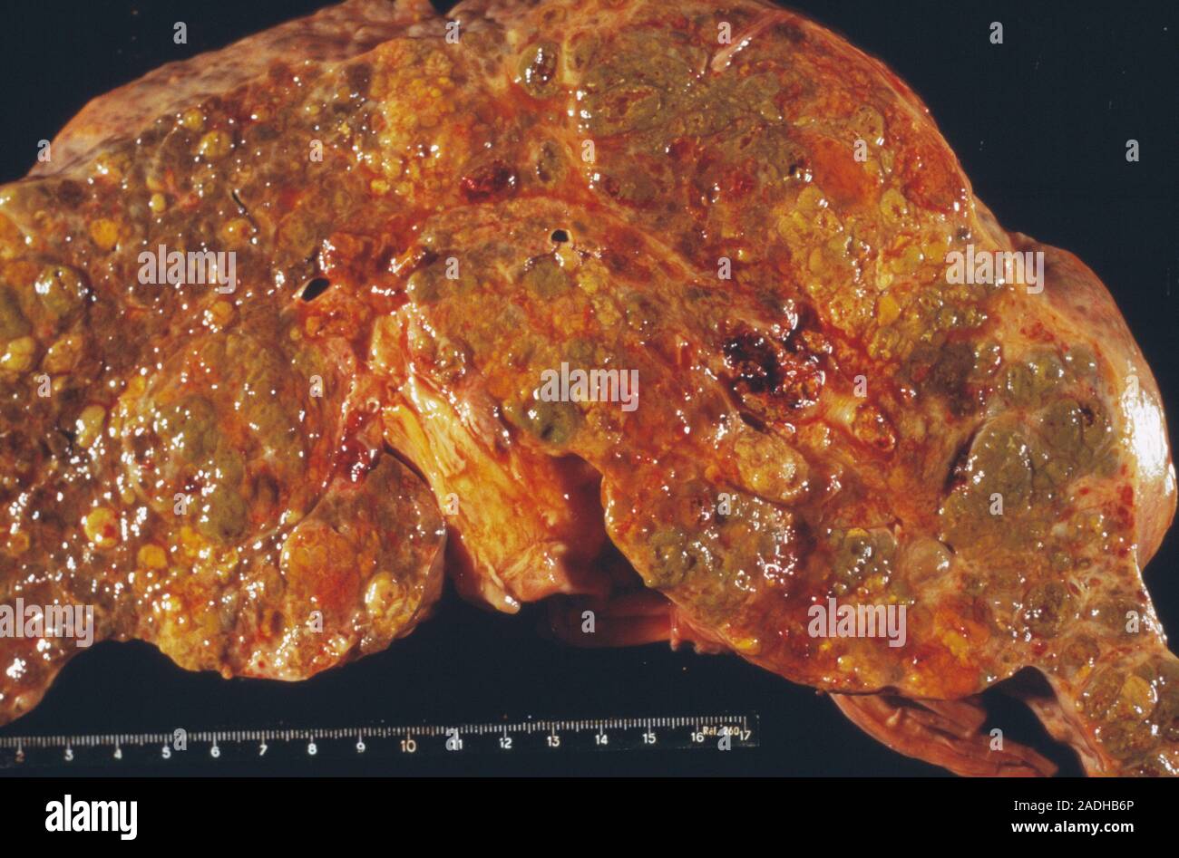 Liver cancer. Gross clinical specimen of a sectioned human liver ...