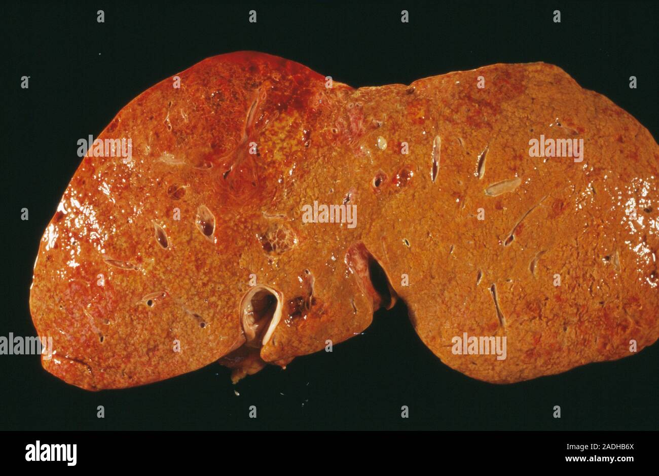 Liver cancer. Sectioned gross clinical specimen of malignant (cancerous) tumours (neoplasms) of ...