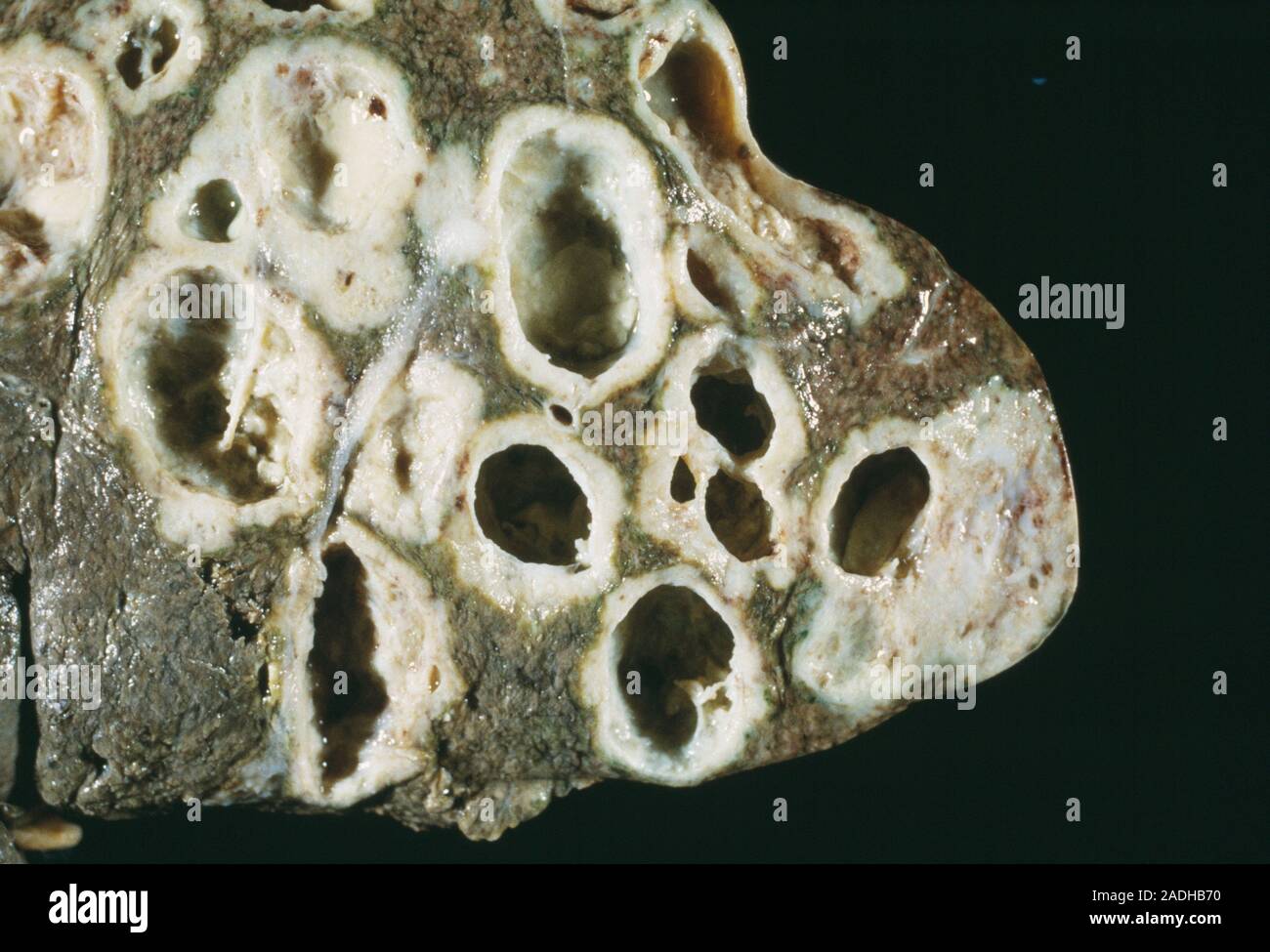 Secondary liver cancer. Sectioned gross clinical specimen of secondary ...