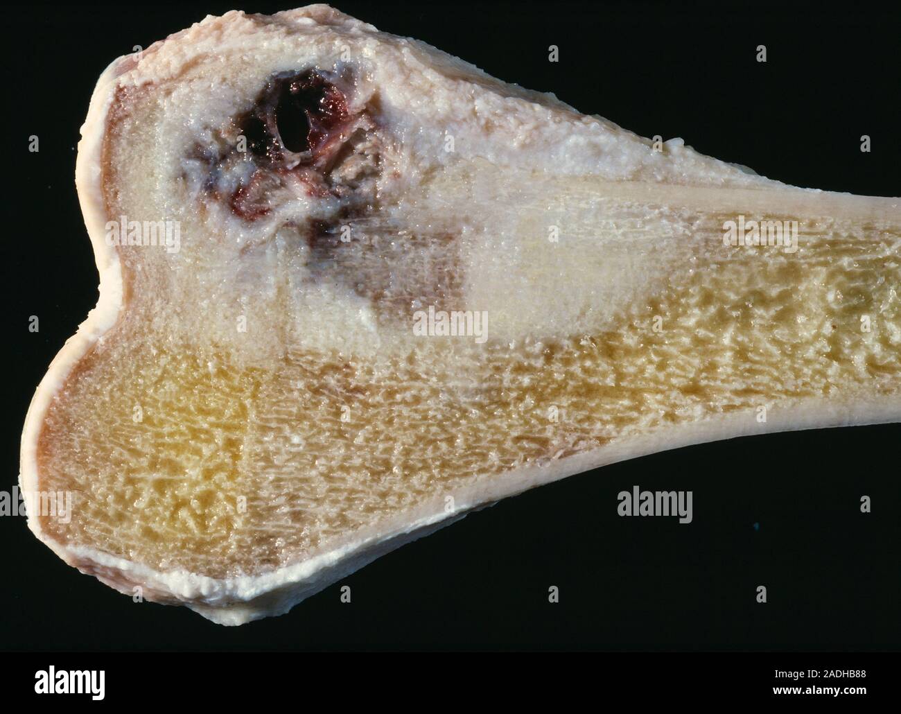 Bone cancer. Gross clinical specimen of bone sectioned to reveal an ...