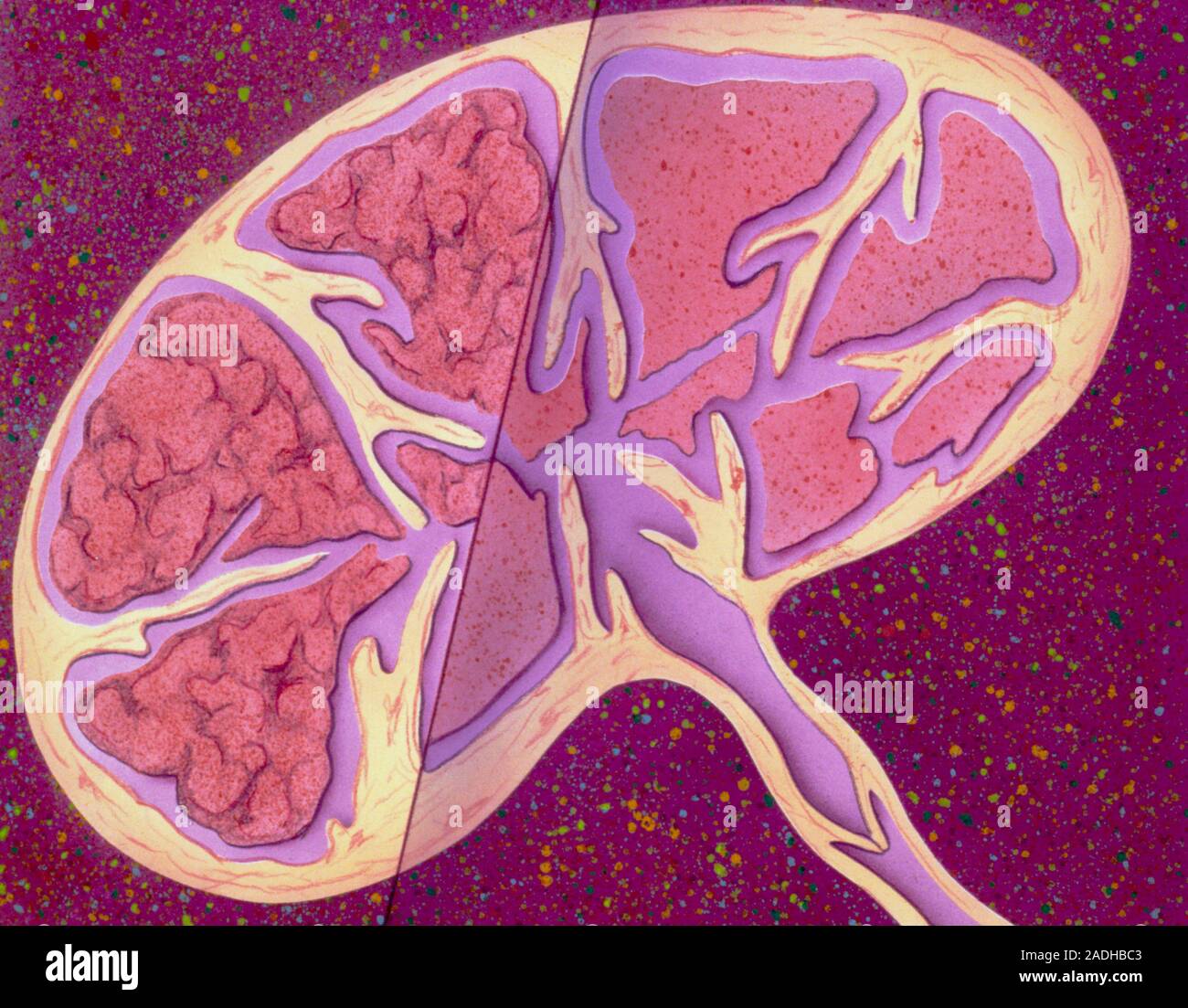 Lymphoma. Artwork of a kidney with non-Hodgkin's lymphoma, a cancer of ...