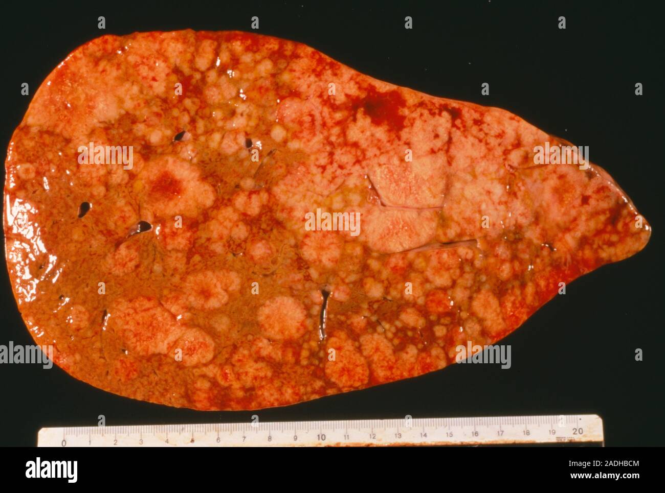 Secondary liver cancer. Sectioned gross clinical specimen of secondary ...