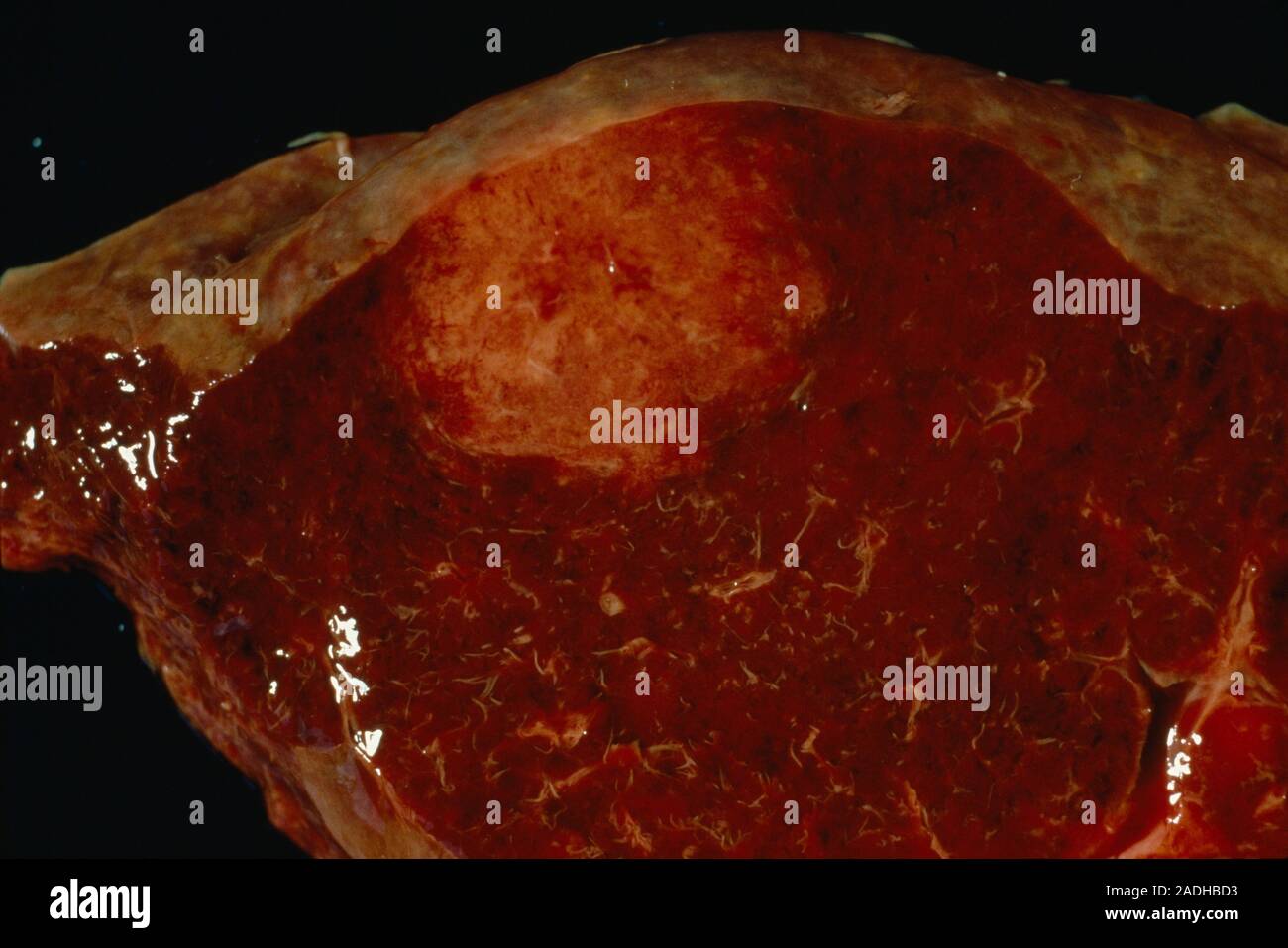 Spleen cancer. Gross specimen of the spleen of a patient showing a ...