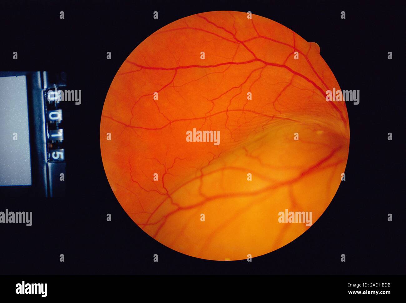 Eye tumour. Ophthalmoscope image of a cancerous growth (pale lump ...