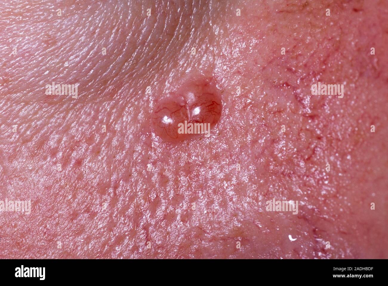Skin Cancer Basal Cell Carcinoma Bcc Or Rodent Ulcer On The Cheek