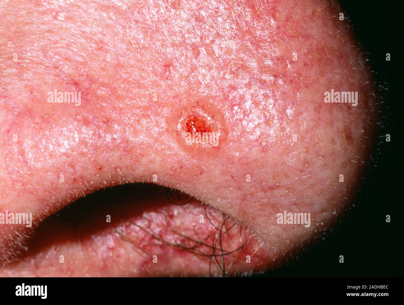 Skin Cancer Close Up Of A Basal Cell Carcinoma Bcc Or Rodent Ulcer On The Nose Of An 57