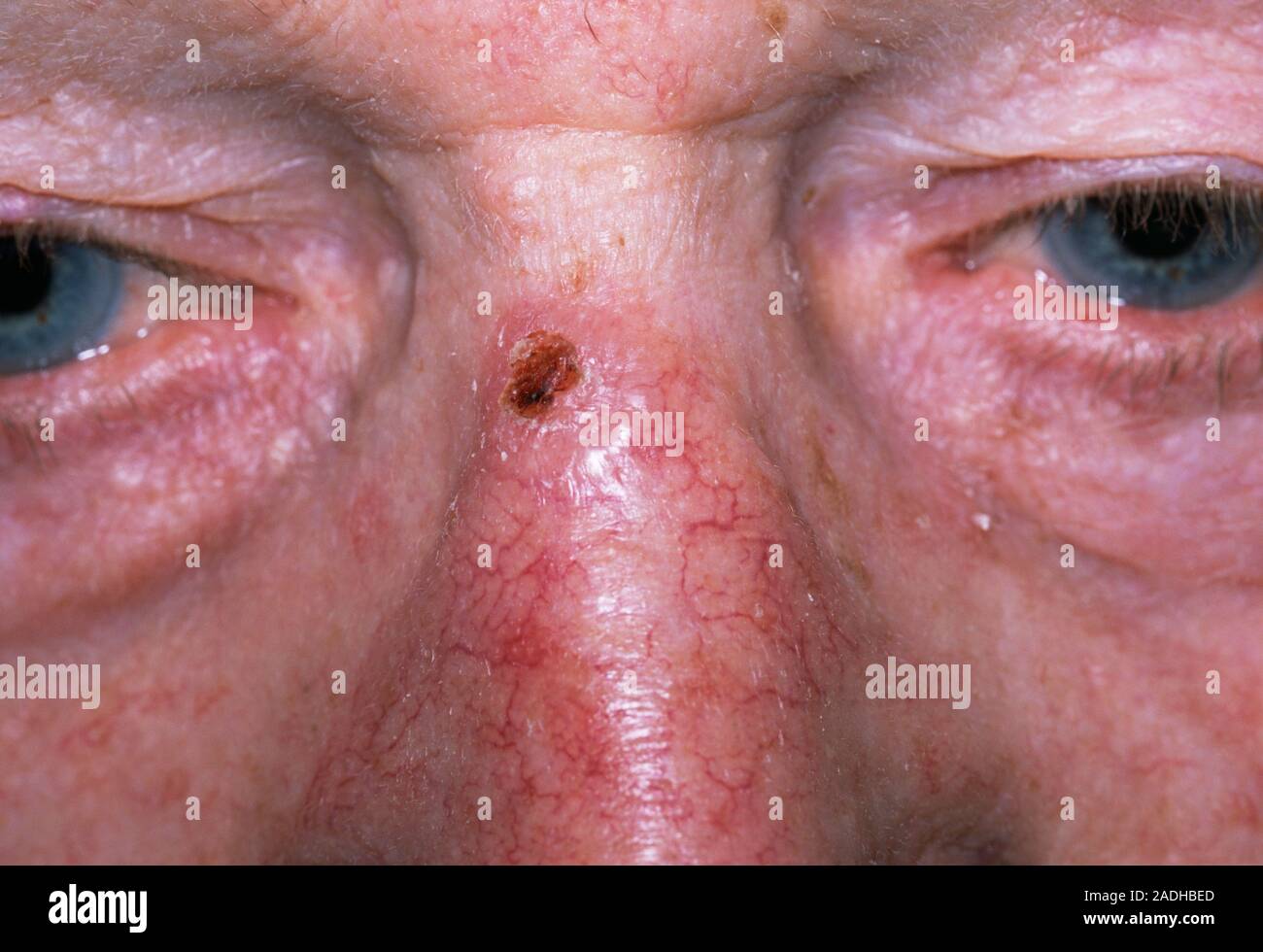 Skin cancer. Basal cell carcinoma (BCC), or rodent ulcer, on the bridge ...