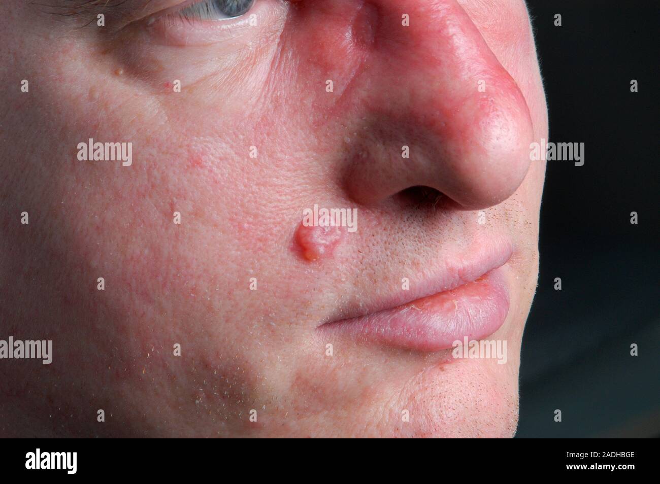 Skin cancer. Basal cell carcinoma (BCC), or rodent ulcer, on the cheek ...