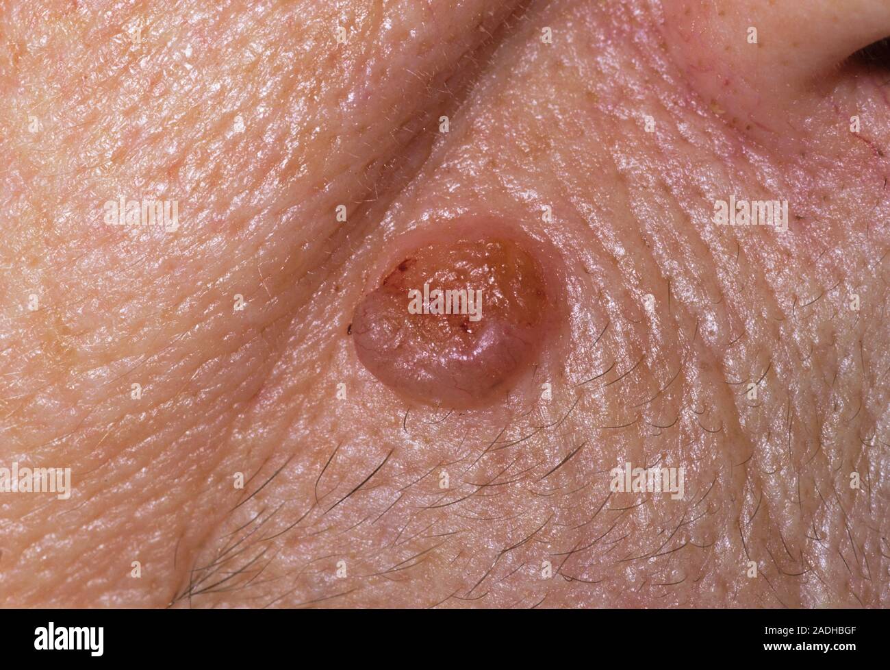 Skin Cancer Basal Cell Carcinoma Bcc Or Rodent Ulcer On The Face Of A 78 Year Old Woman
