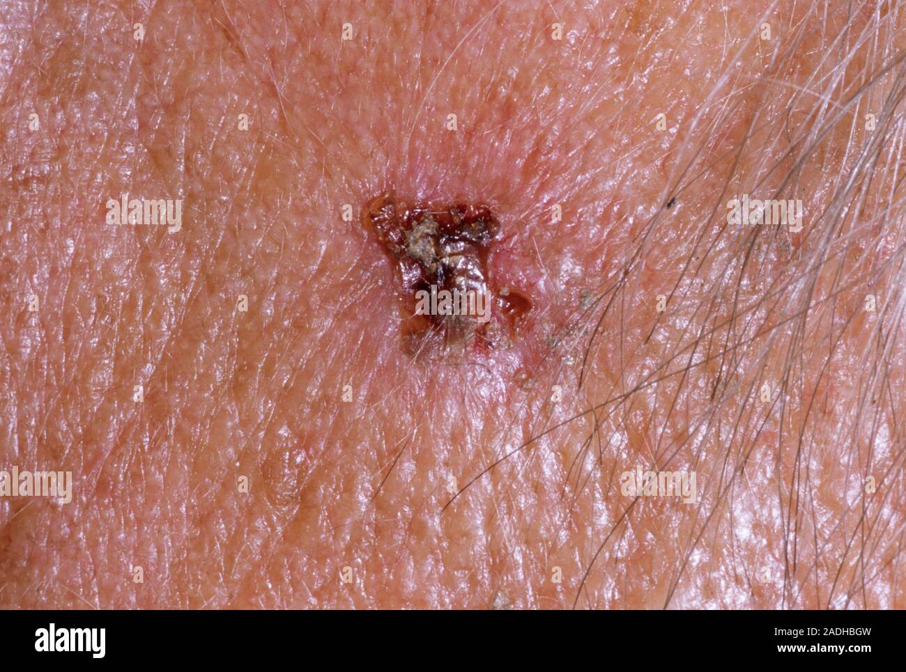 Skin cancer. Basal cell carcinoma (BCC), or rodent ulcer, on the skin ...