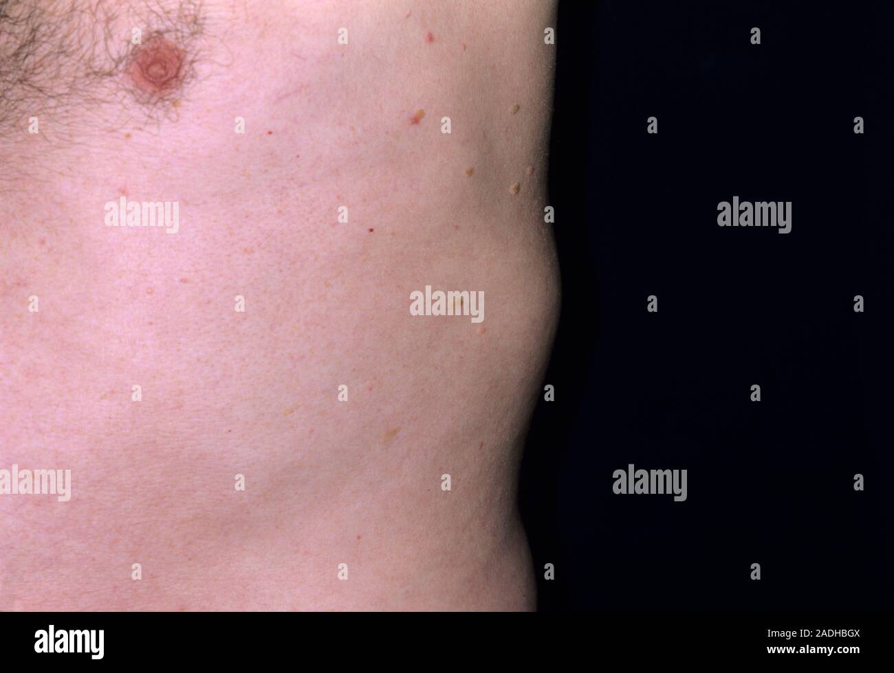 Lung cancer. 61-year-old man with a swollen chest wall, indicating the ...